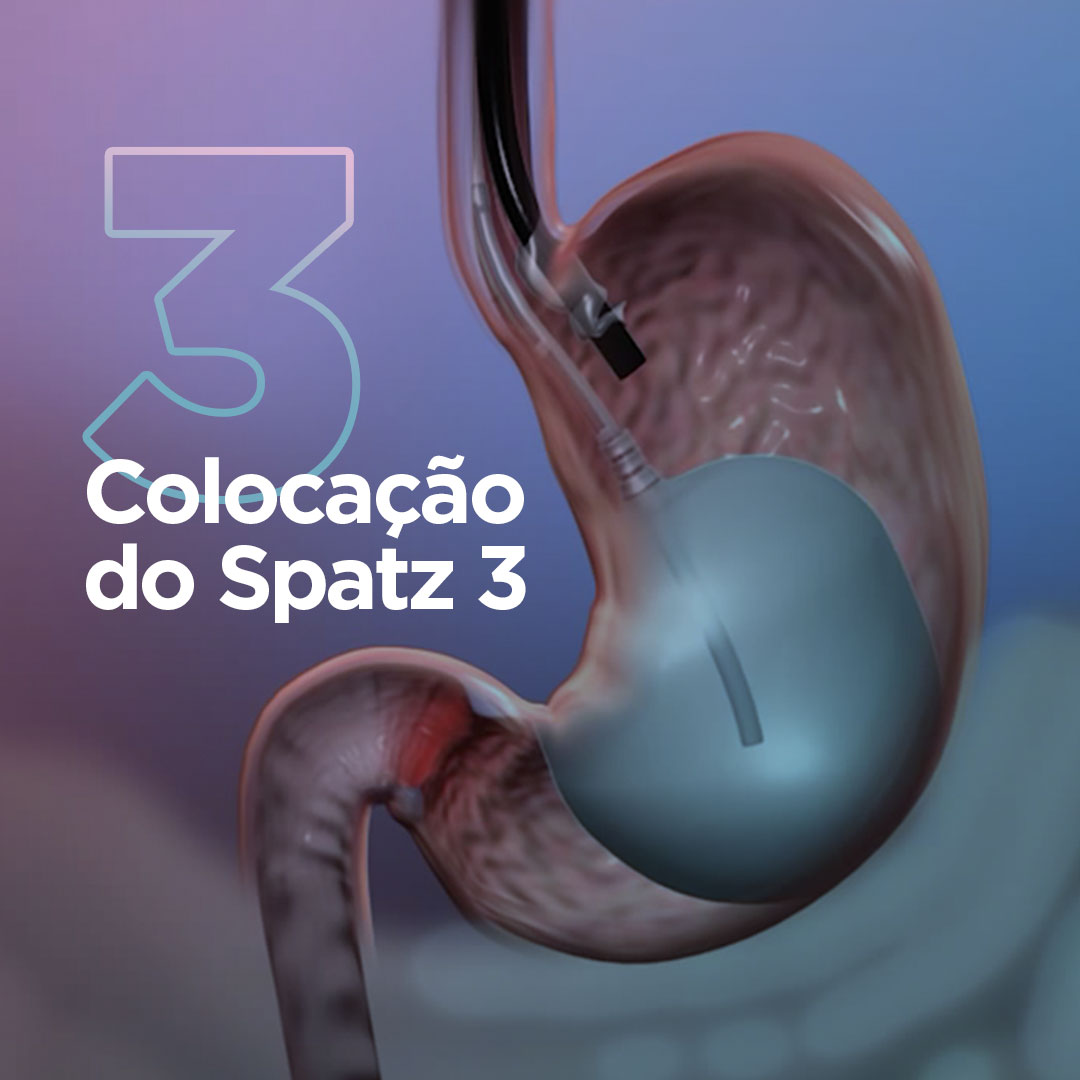 Balão Intragástrico: saiba onde você pode colocar o Balão Spatz 3 ...